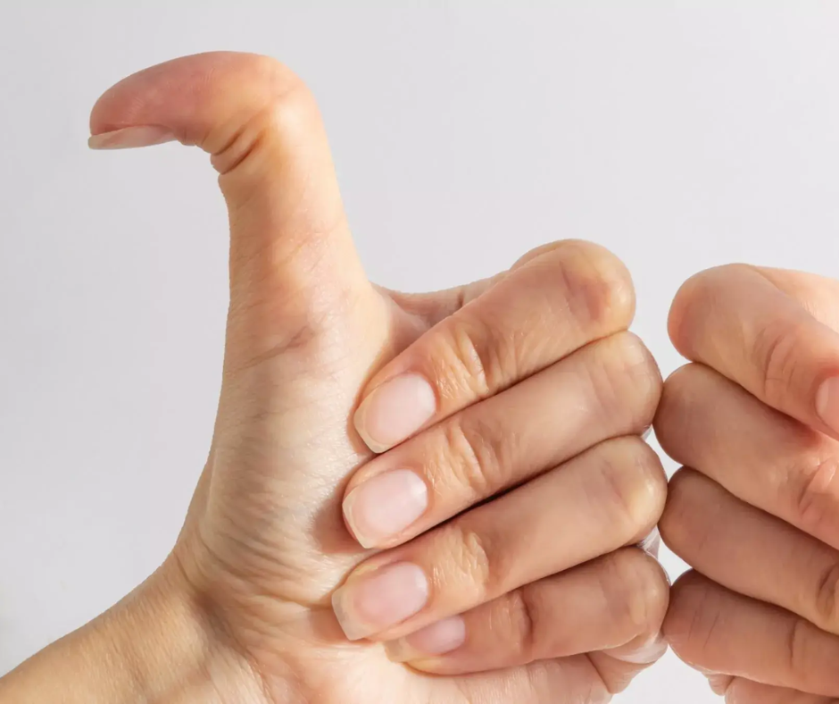 Causes Of Hypermobility Archives Iowa Ortho